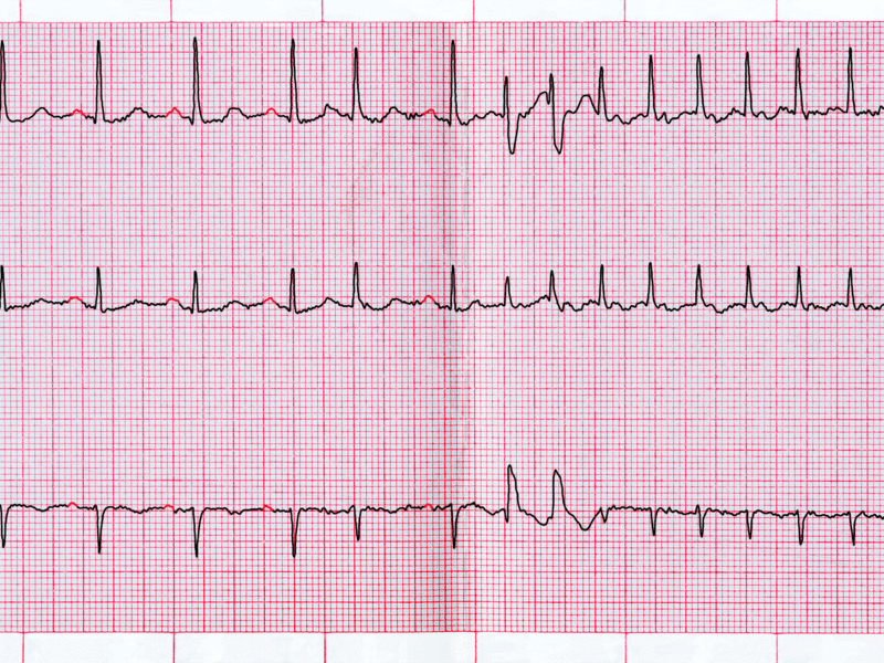 Wearable heart monitors reveal otherwise undetected atrial fibrillation